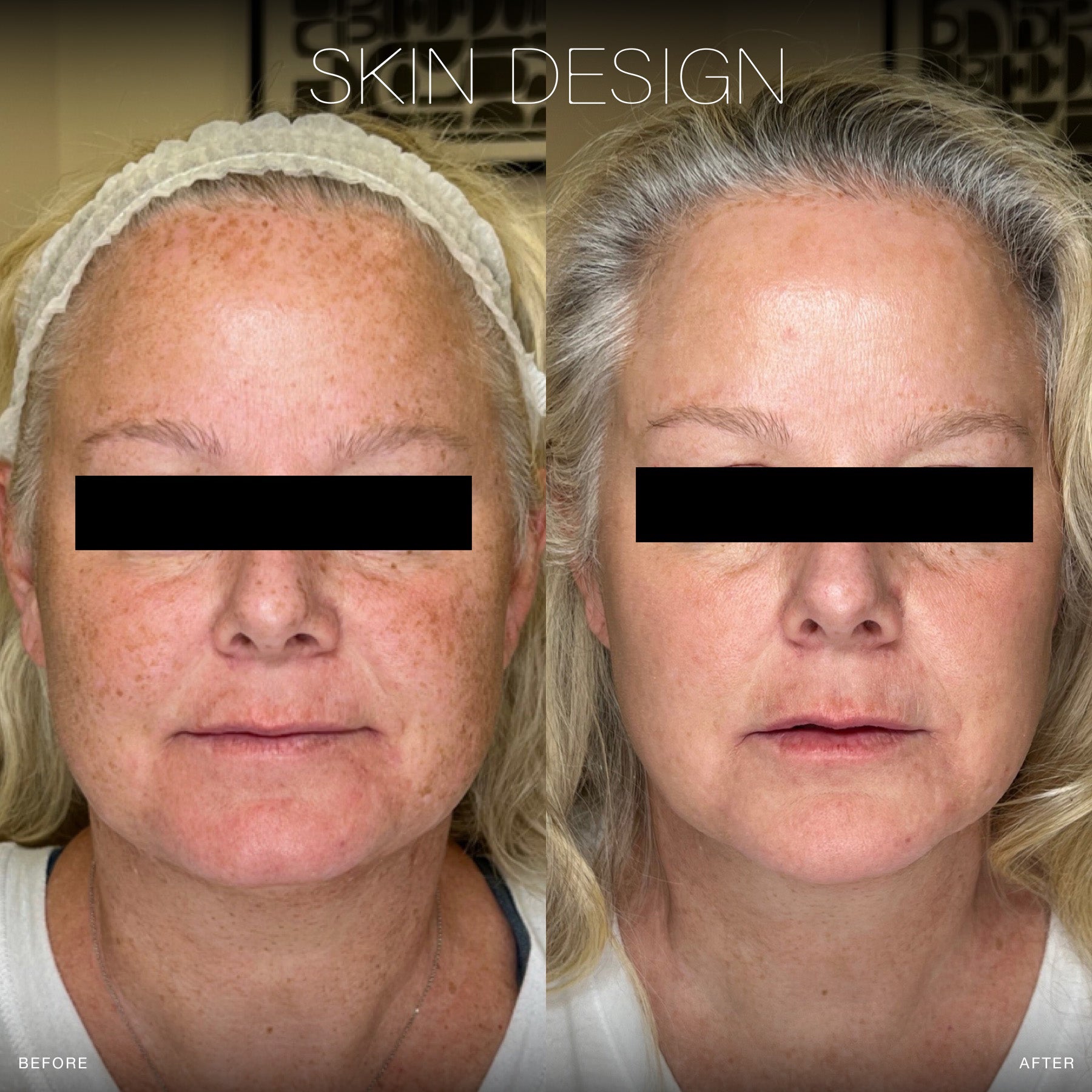 Forever Young Bbl Laser Treatment Skin Design Aesthetics Med Spa In