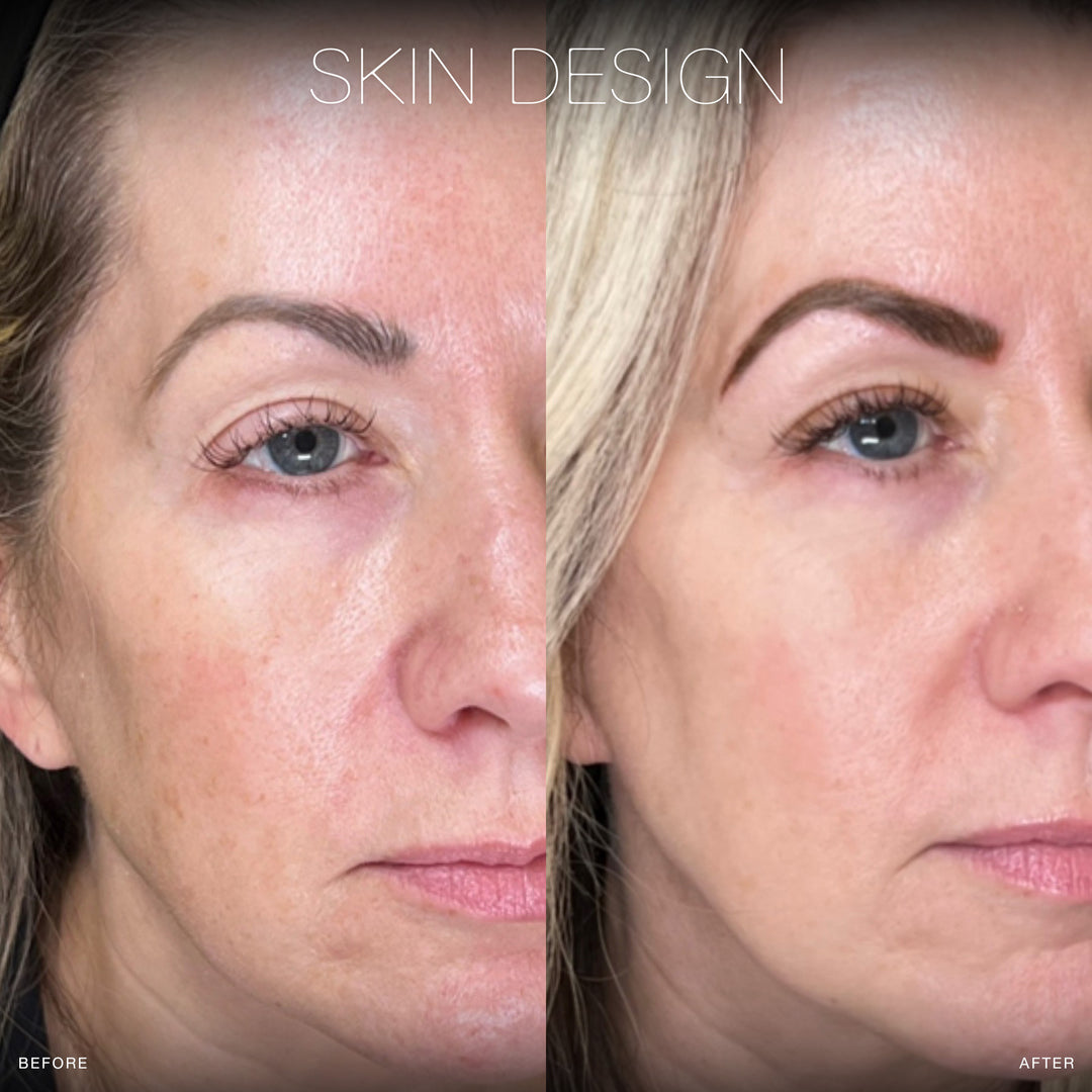 Forever Young BBL Laser Treatment | Skin Design Aesthetics | Med Spa in ...